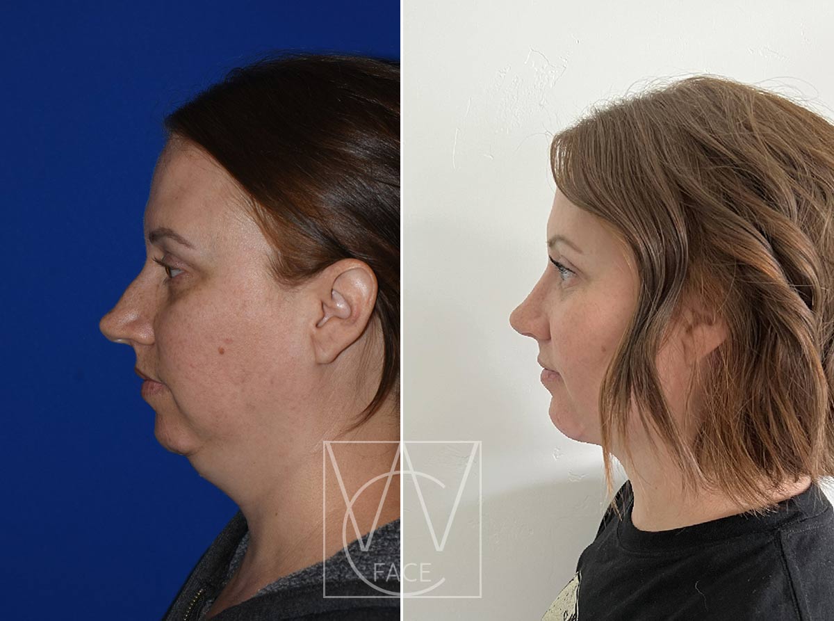 Rhinoplasty Gallery - West Coast Face