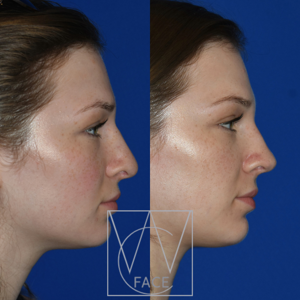 Rhinoplasty Portland Oregon | Nose Surgery